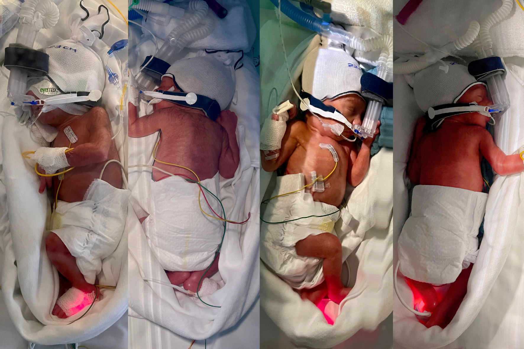 Viereiige Vierlinge im Perinatalzentrum Hamburg-Altona geboren - SAT.1 ...